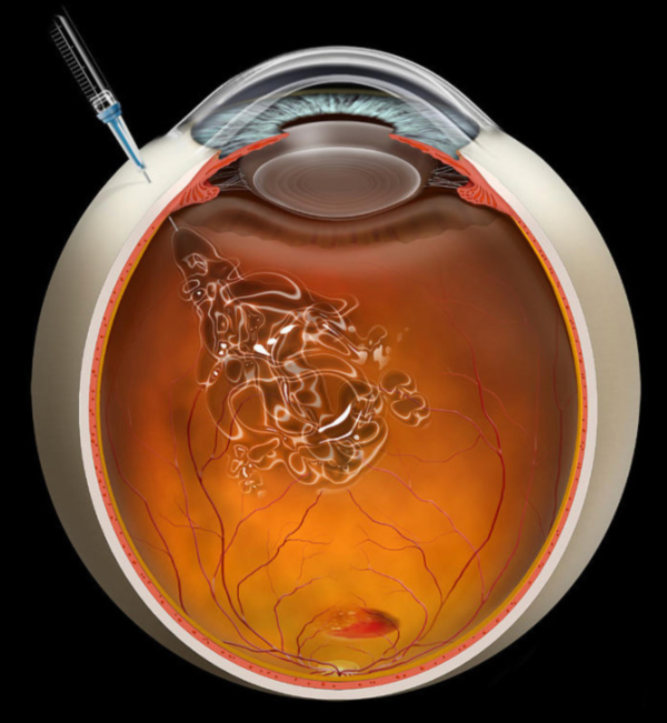 Intravitreal Injections - Retina Center of San Diego