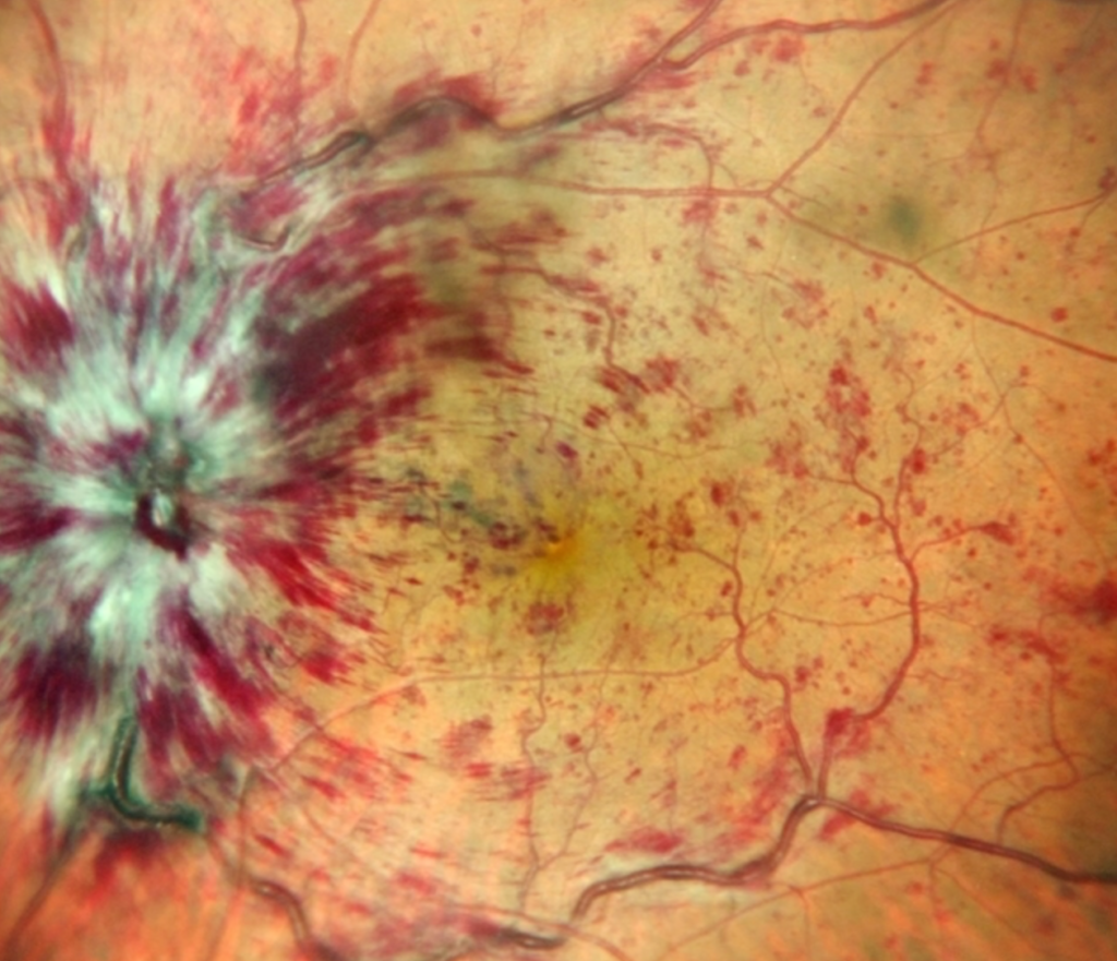 Retinal Vein Occlusion - Retina Center of San Diego
