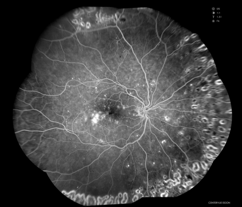 Fluorescein Angiography - Retina Center of San Diego