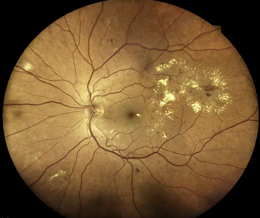 Diabetic Macular Edema - Retina Center of San Diego